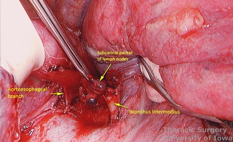 Esophagectomy: Three-field (McKeown) - Laparotomy and Right Thoracoscopy (Thoracotomy) with ...